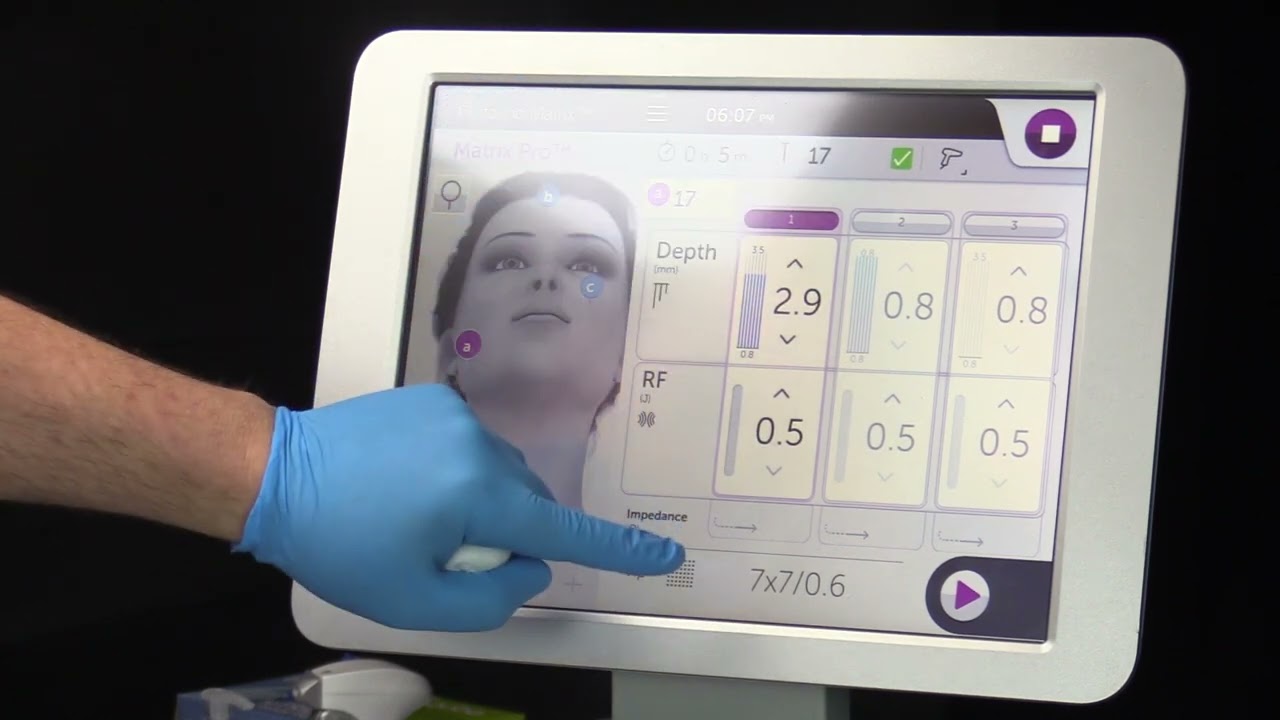 Candela Profound Matrix Demonstration - James Newman, M.D. - The ...